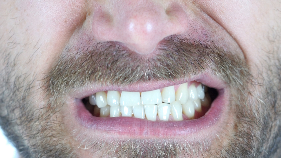 Chipped Teeth From Grinding