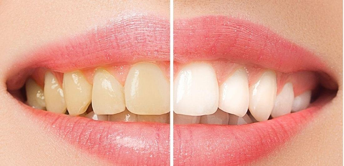Teeth Whitening: Steps to a Whiter and Brighter Smile! | Teeth ...